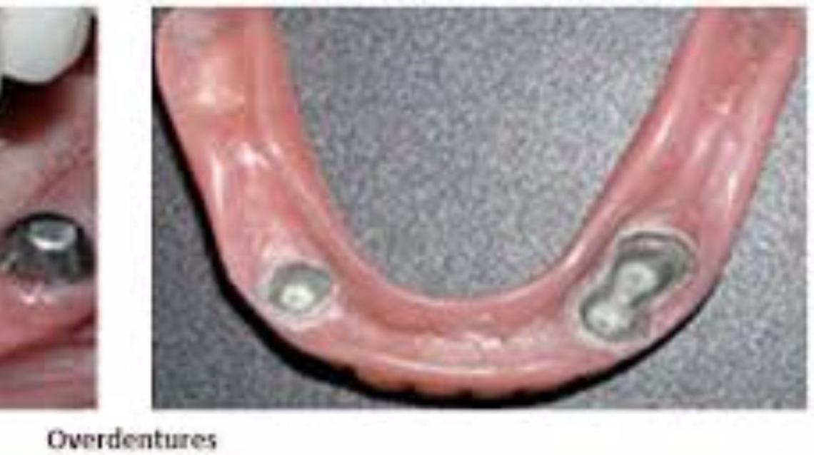 Overdentures Are Better Then Dentures