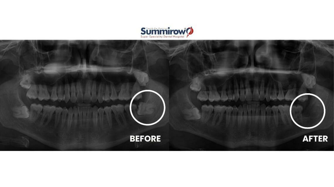 Surgical Removal of Horizontally Impacted #38 to Relieve Jaw Pain and ...