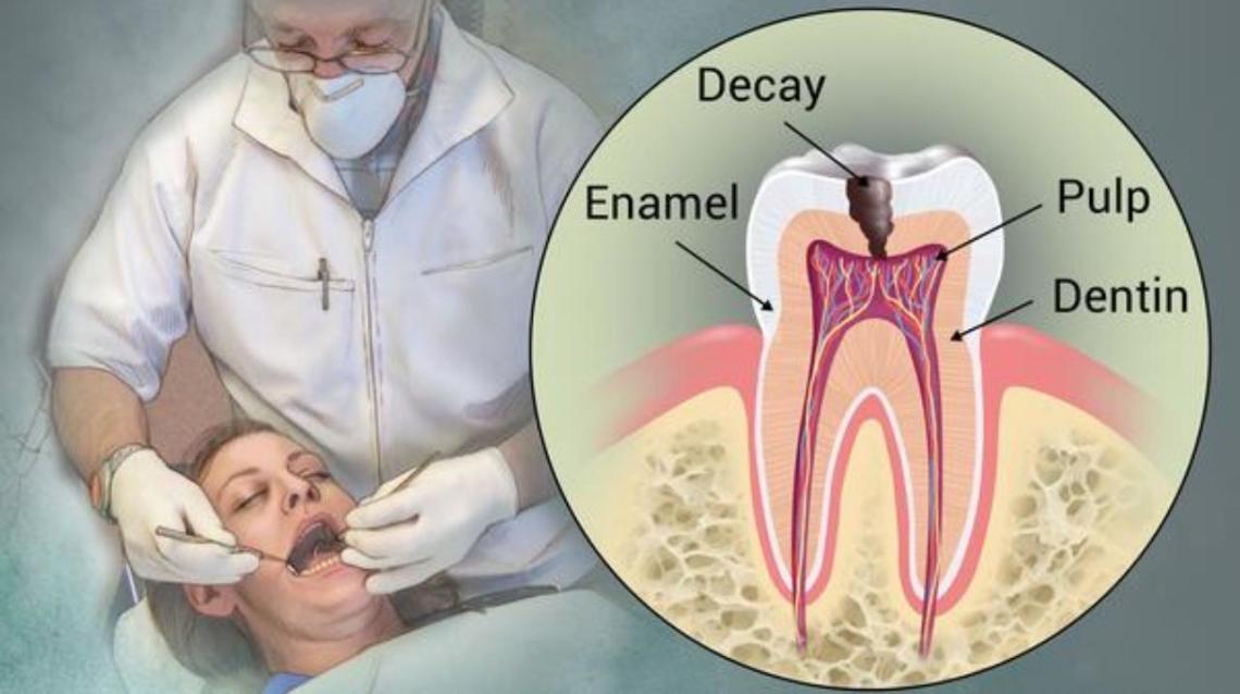 What To Do In Case Of A Tooth Decay