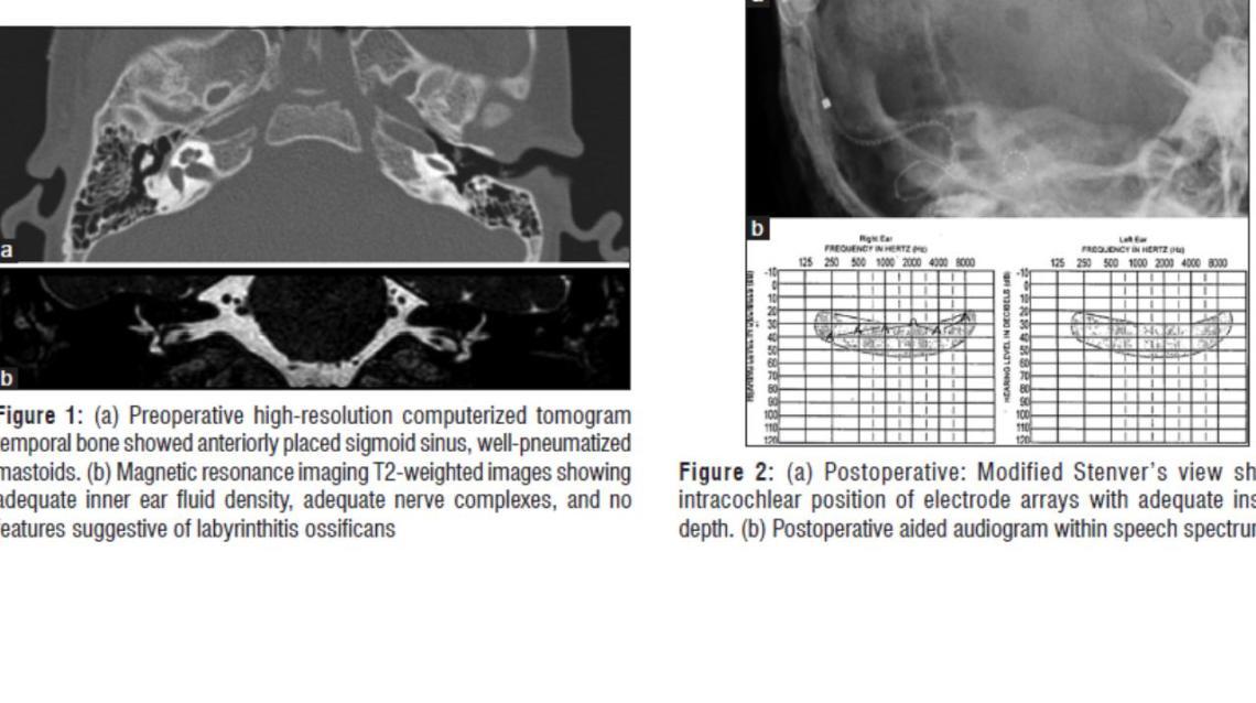 Simultaneous Labyrinthectomy and Cochlear Implantation