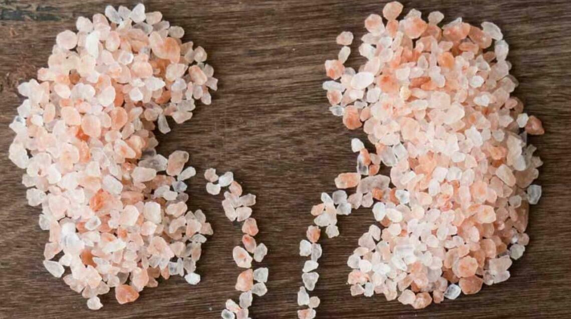 Kidney Stones
