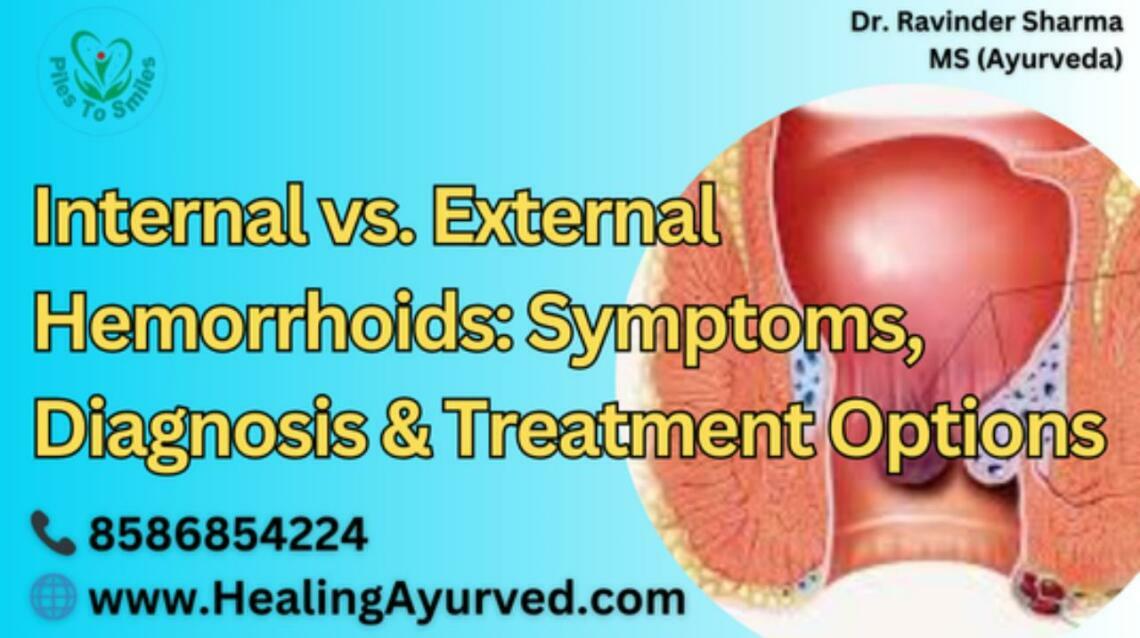 Internal vs. External Hemorrhoids: Symptoms, Diagnosis & Treatment Options