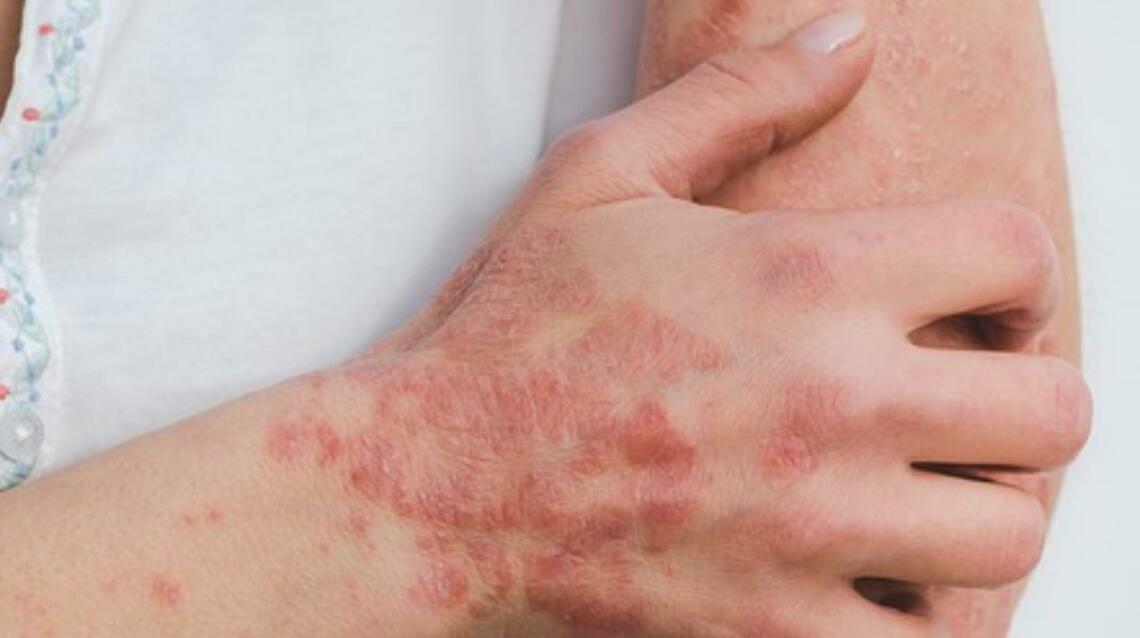 "Navigating Psoriasis: Expert Insights and Advanced Care at Radiance ...