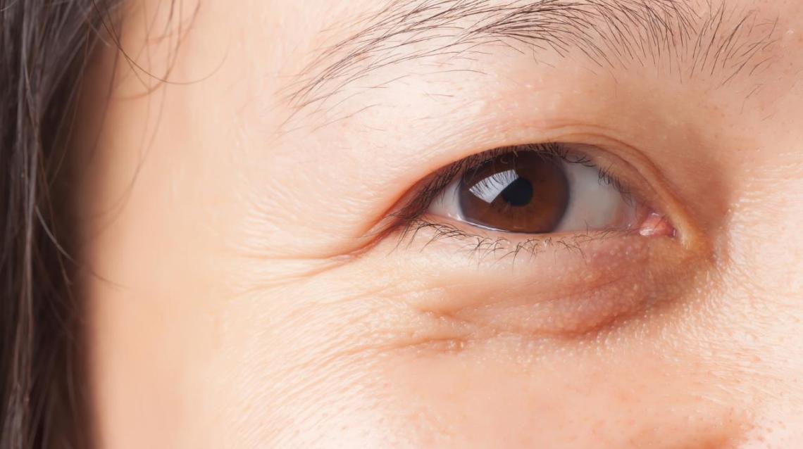 Popular Treatment Options for Under-Eye Problems
