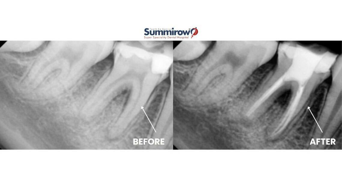 Root Canal Treatment for Painful Lower Right Molar