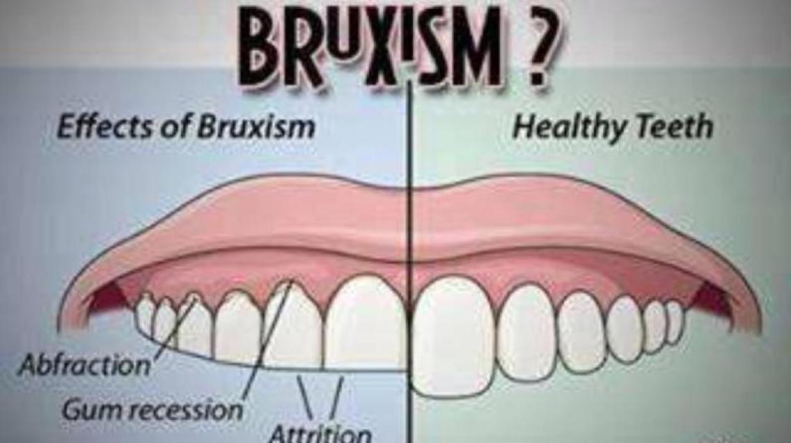 Bruxism - Night Grinding Of Teeth