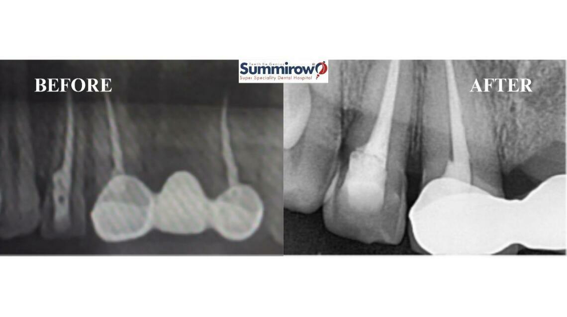 Reroot Canal Treatment (Rerct) for Chronic Apical Periodontitis in a ...