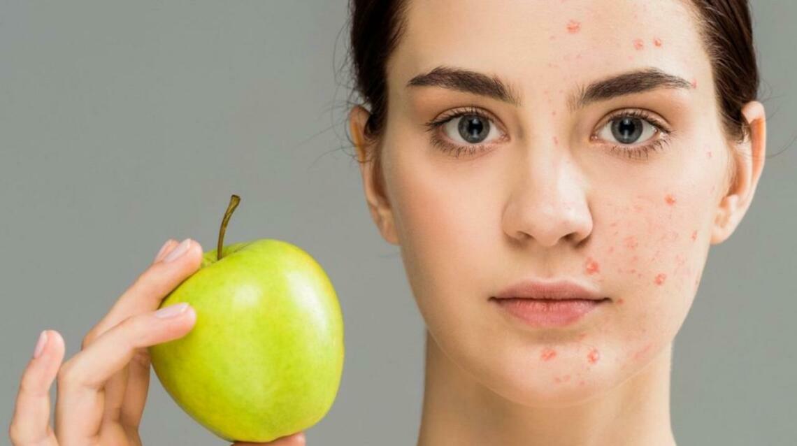 The Connection Between Acne and Diet: What to Eat and Avoid for Clearer ...