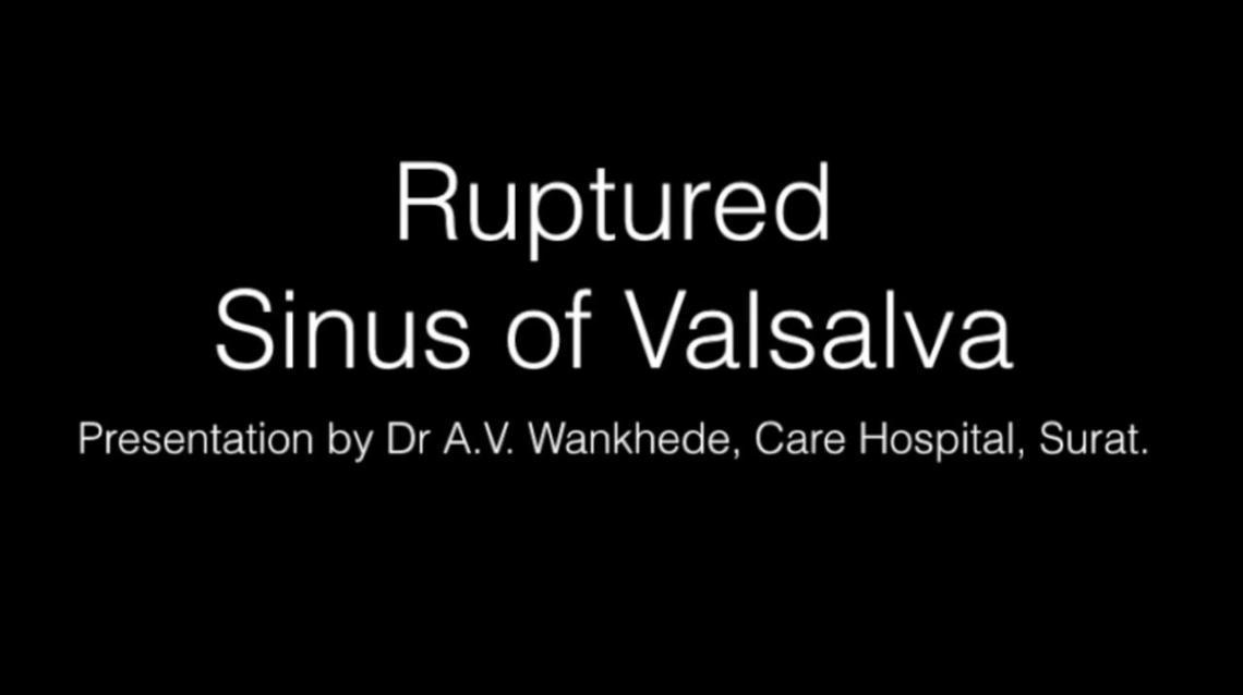 Ruptured Sinus of Valsalva (RSOV) - a Rare Clinical Entity