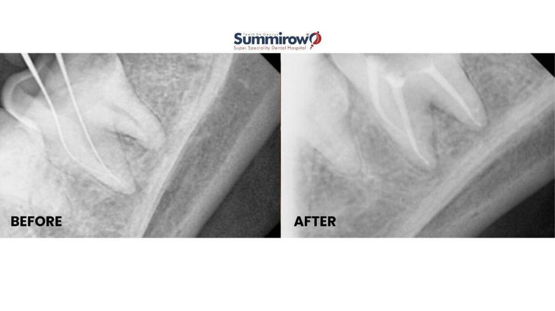 Root Canal Treatment for Deep Cavity in Tooth 37: Relieving Pain and ...