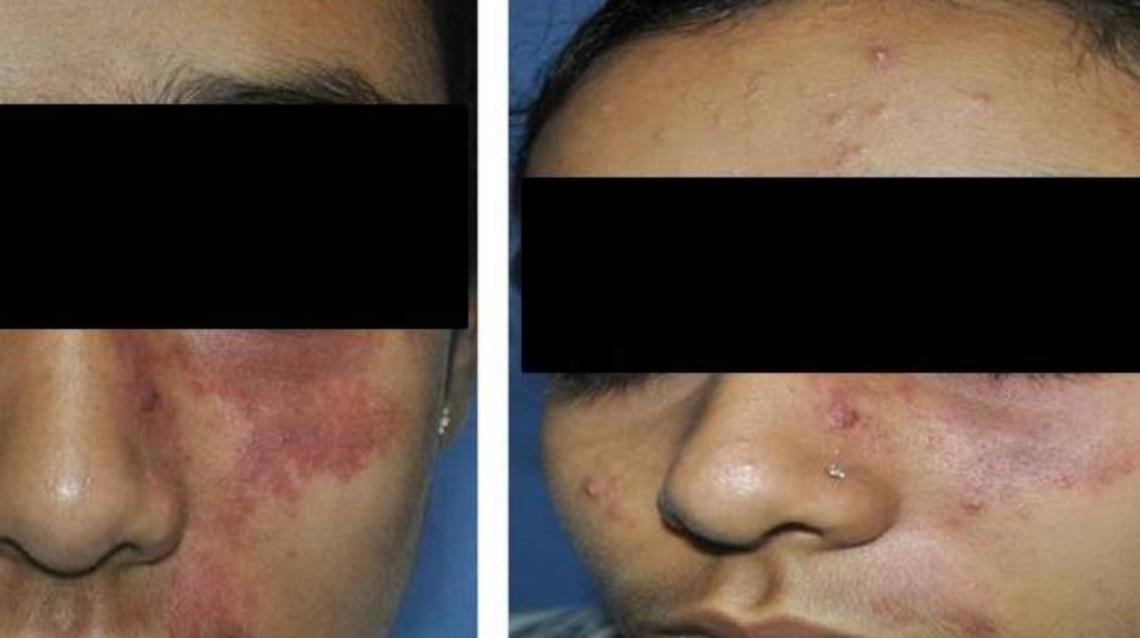 What Is a Birthmark?