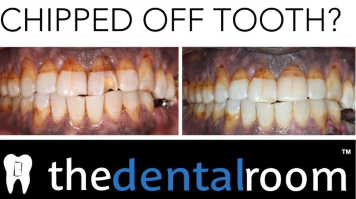 Chipped Off Tooth?