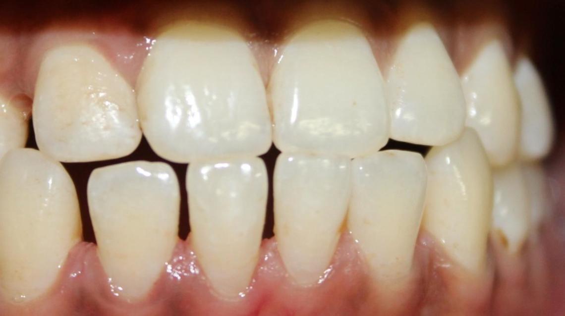 Treatment of Discolored Teeth