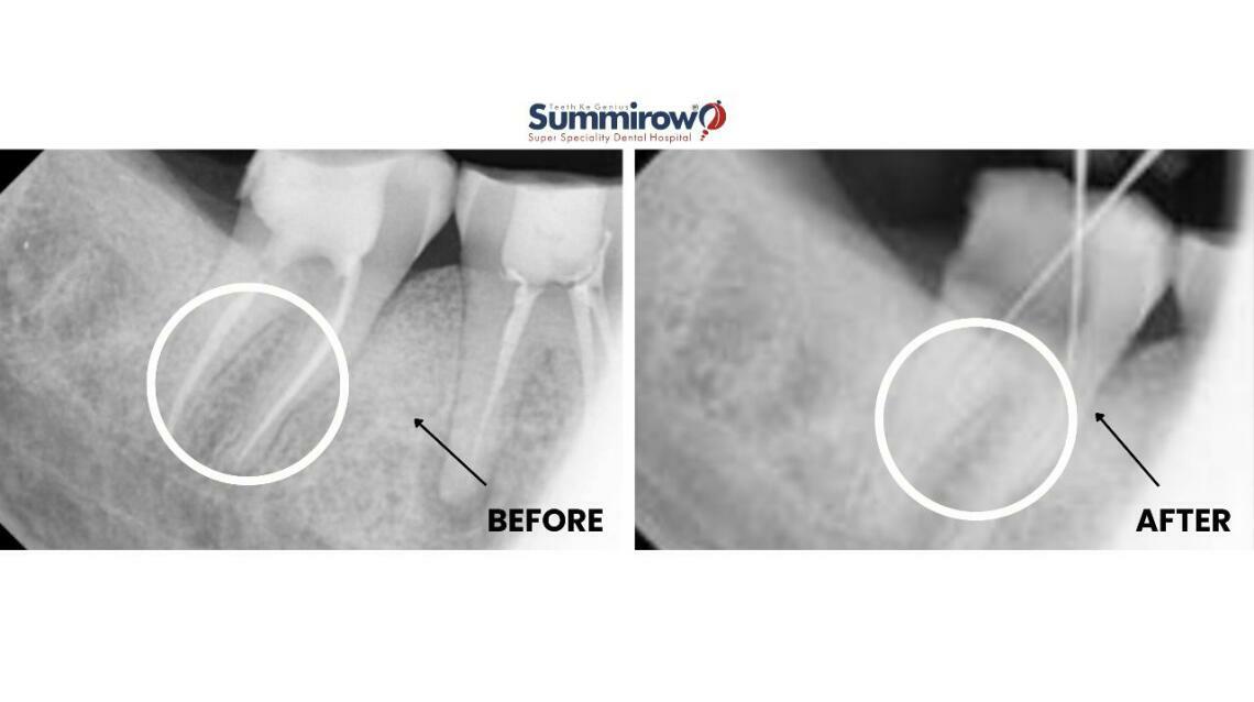 Root Canal Treatment in Tooth 47 (Lower Right Second Molar)