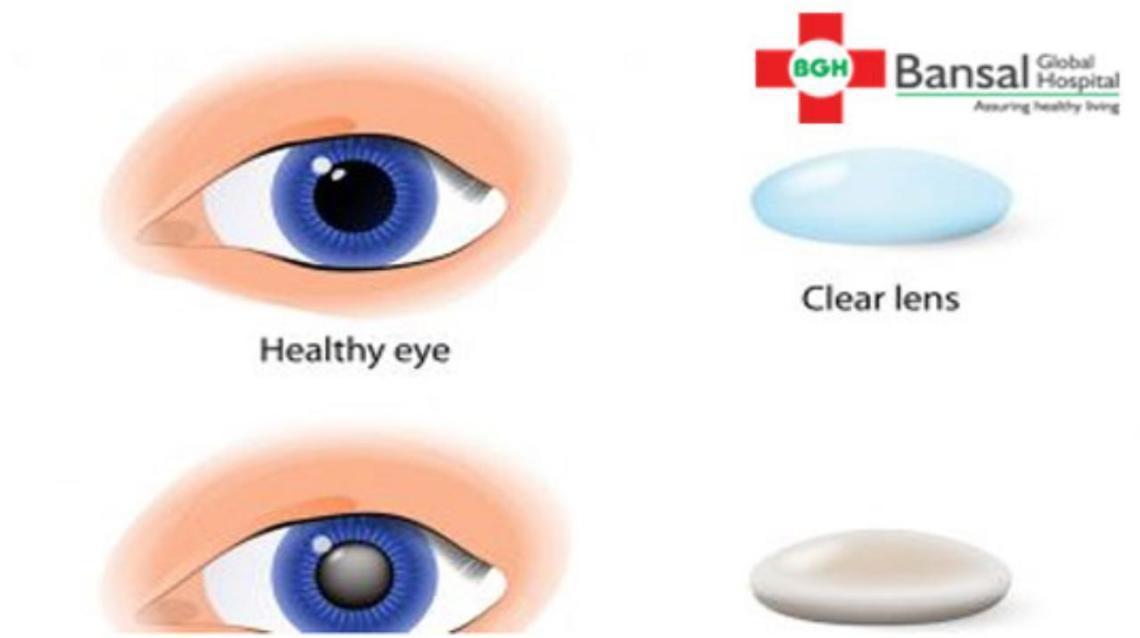 Understanding the Symptoms of Cataract