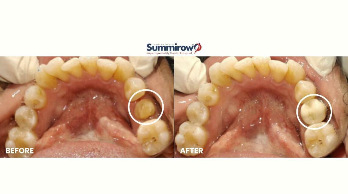 Case Study: Restoring Function and Aesthetics With a Pfm Crown After ...