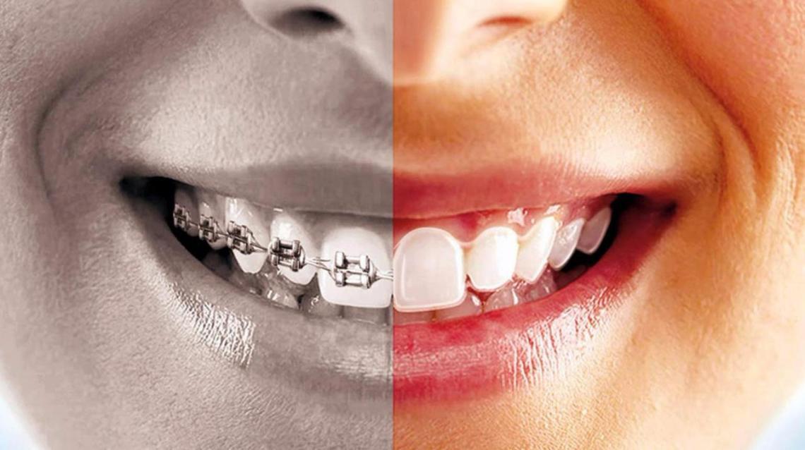 Goodbye Braces, Hello Clear Aligners?