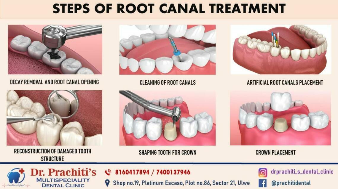 What Is Root Canal Treatment / Rct