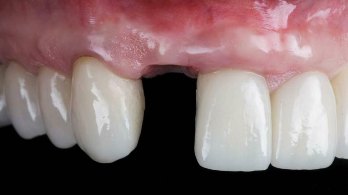 Missing Teeth Replacement Missing Teeth Replacement