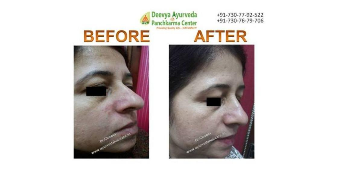 Define Rosacea.
