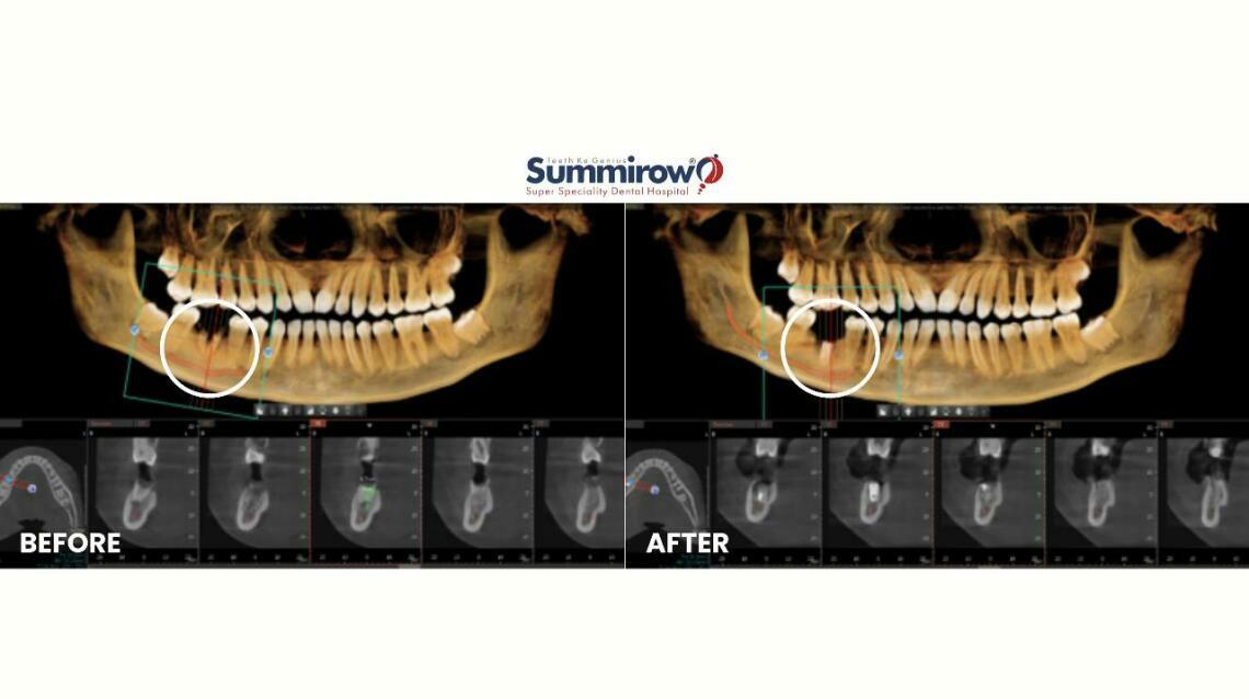 From Broken Tooth to Fixed Solution Immediate Implant Placement in ...
