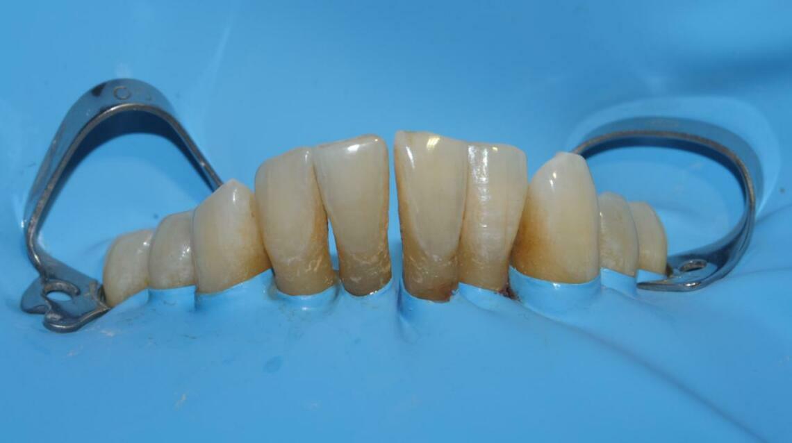 How to Fix Mobile Teeth in One Sitting Easily & Economically