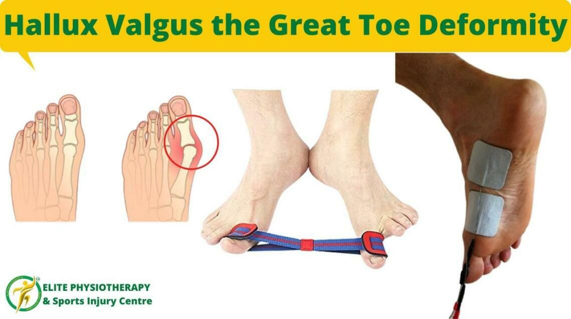 Hallux Valgus the Great Toe Deformity