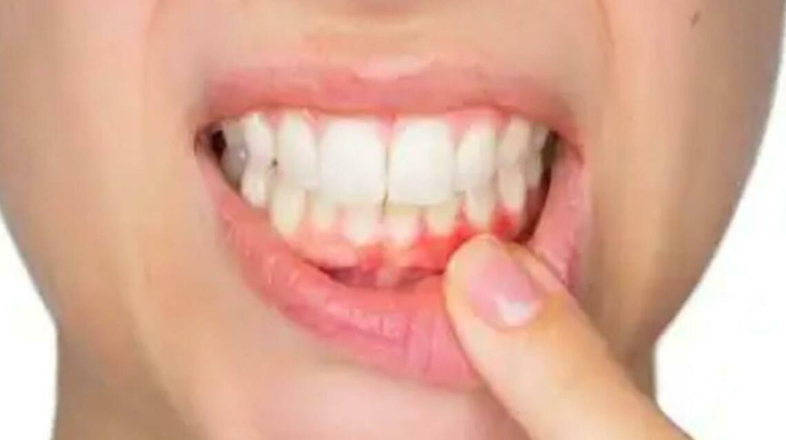 What Is Pyorrhea: Types, Causes, Symptoms