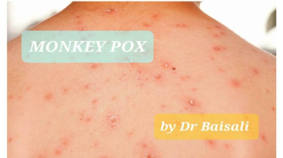 Are You Facing Flu Like Symptom With Rashes? Exclude Monkey Pox