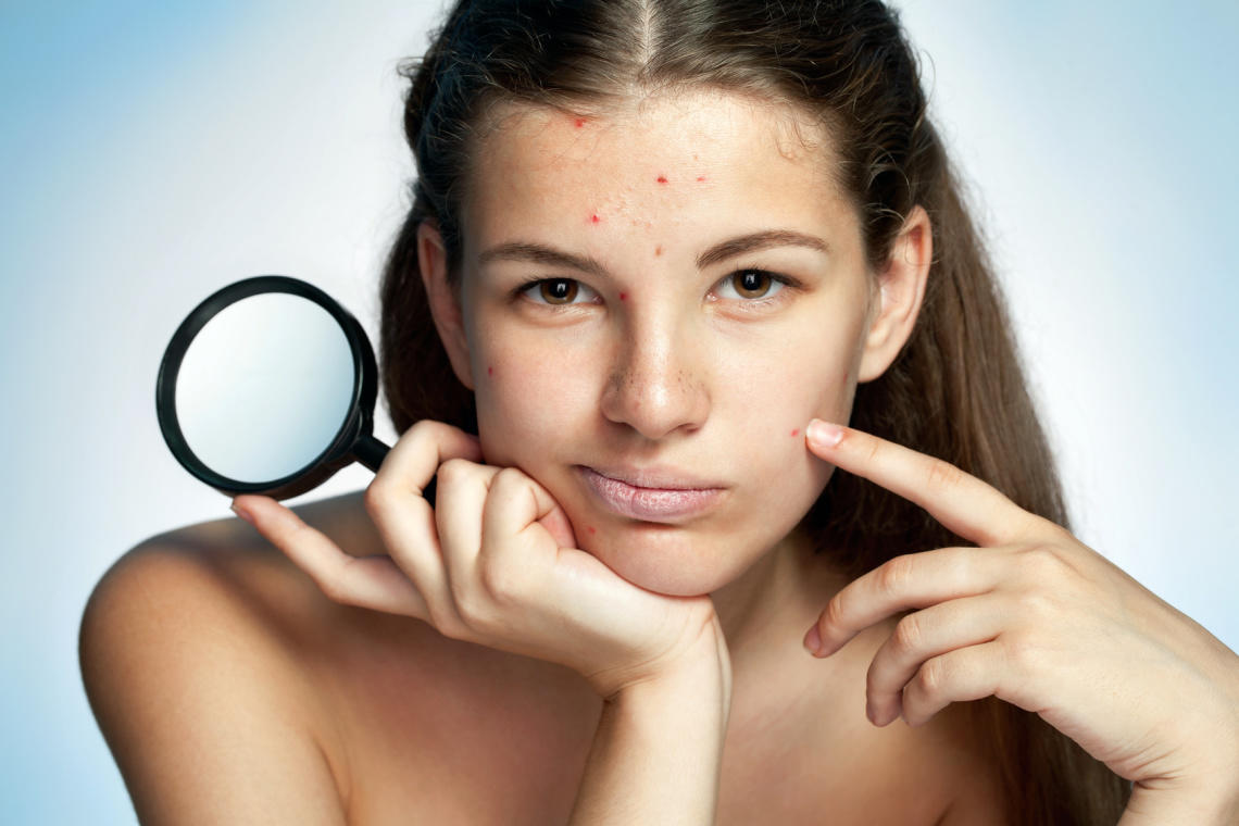 Pimples Due To Cosmetics (Acne Cosmetica)