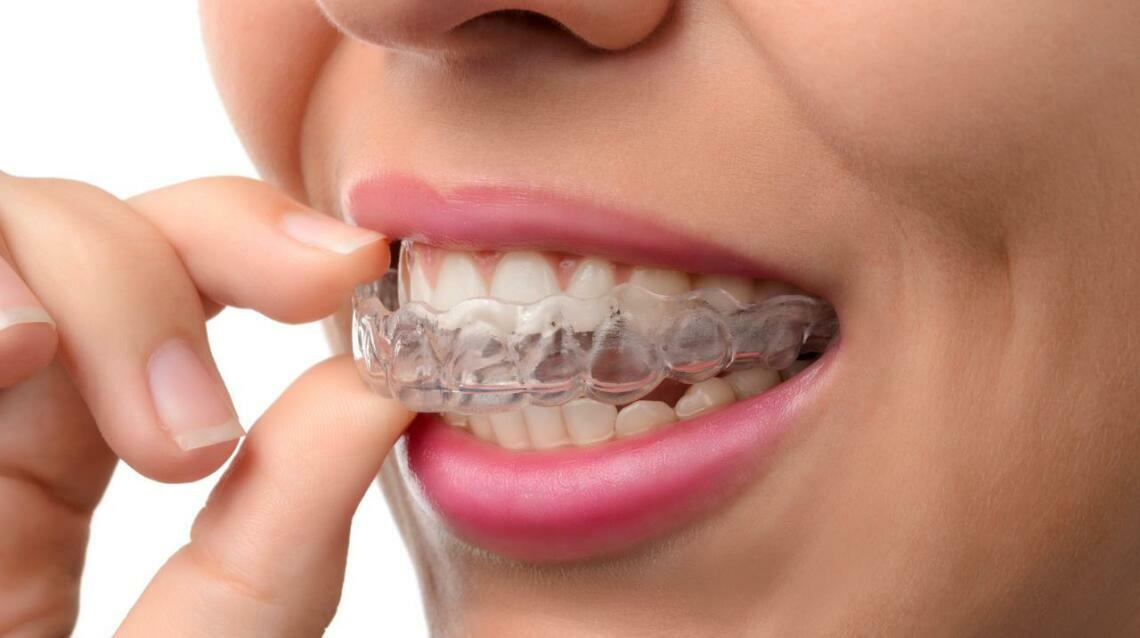 Clear Aligners: The Perfect Smile Solution