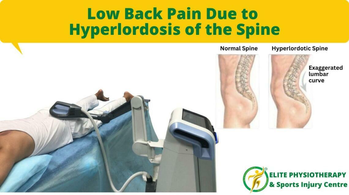 Low Back Pain | Hyperlordosis | Physiotherapy Management