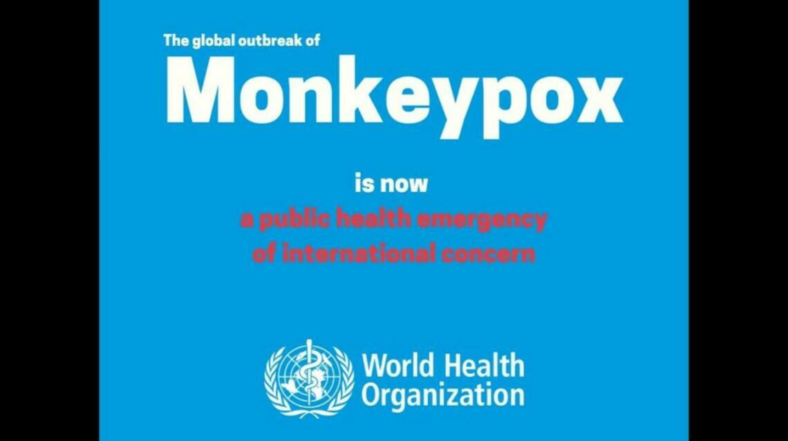 Monkeypox, All You Need to Know.