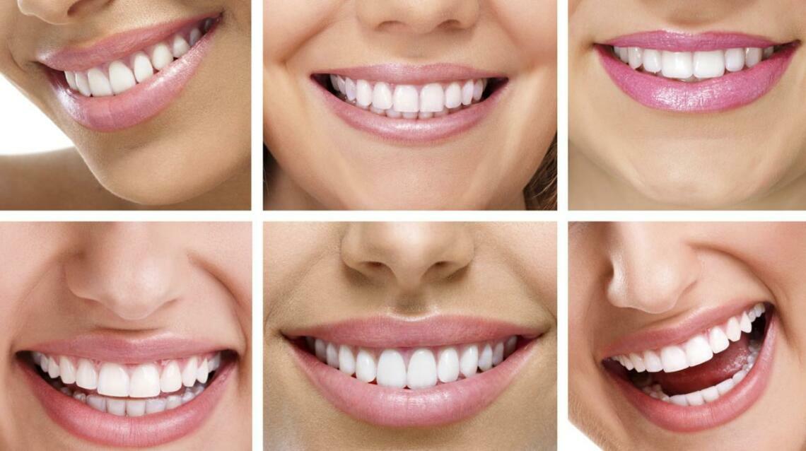 What Is a Smile Design?