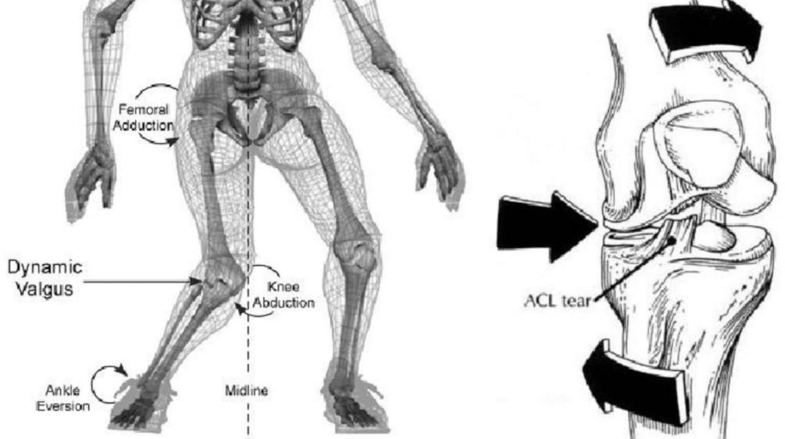 Anterior Cruciate Ligament Tear#surgery or Not@knee Joint